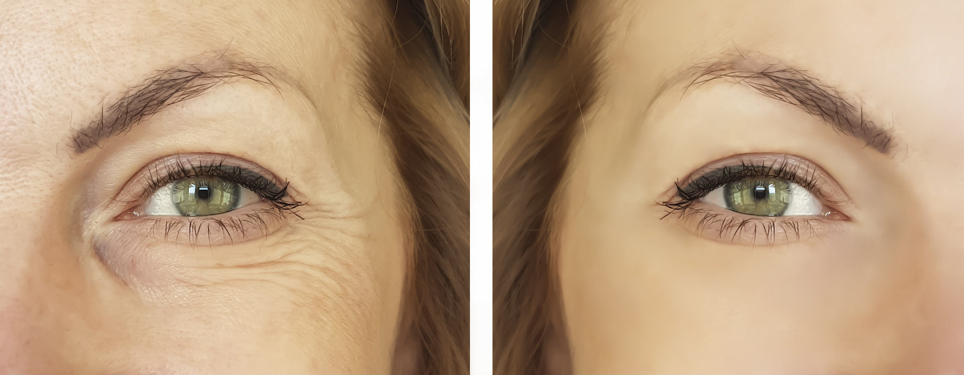 Downtown Los Angeles Anti-wrinkle Photo Light Therapy | Photorejuvenation