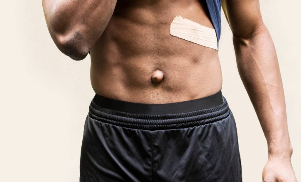 Downtown Los Angeles Ventral/Epigastric Hernia Repair, Symptoms, Treatment